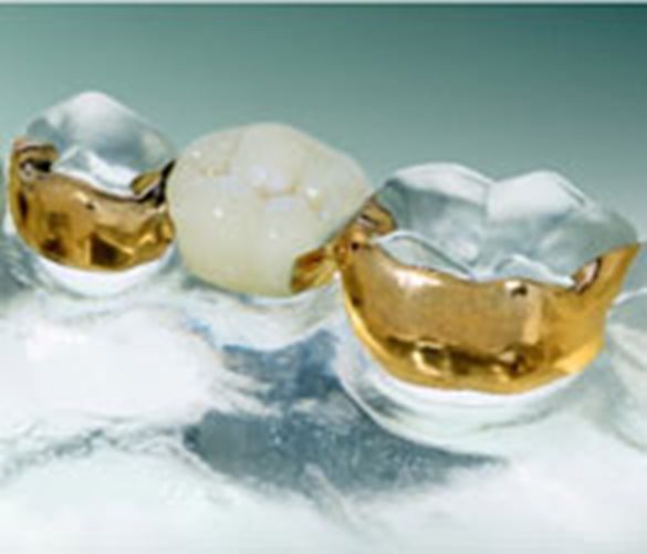 Bridge dentaire collé Maryland Tunisie : Prothèse dentaire Maryland Bridge